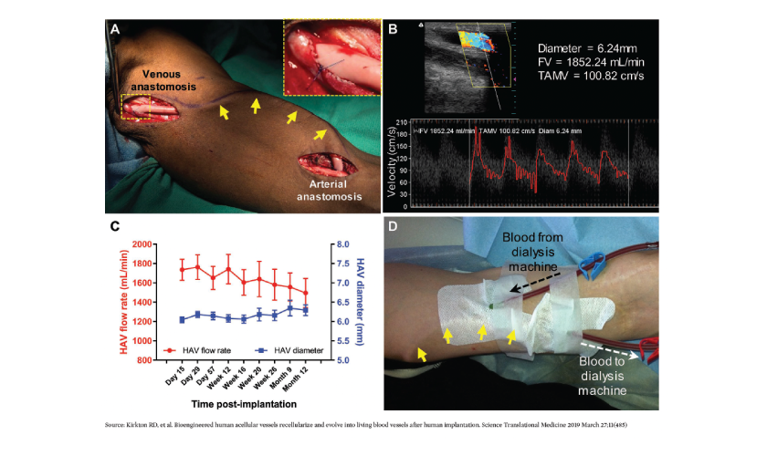 Patient-Centered Vascular Access Care | FMCNA
