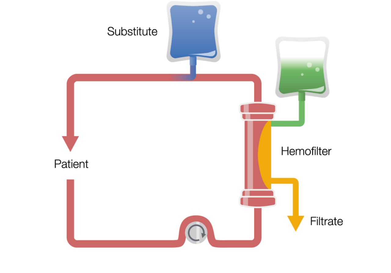 Configuraciones de la CRRT | Fresenius Medical Care