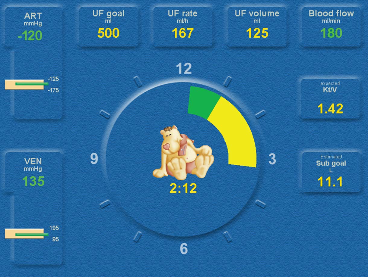 Pediatric hemodialysis | Fresenius Medical Care