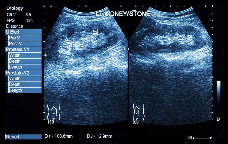 I have kidney disease | Fresenius Medical Care