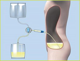 My therapy options | Fresenius Medical Care