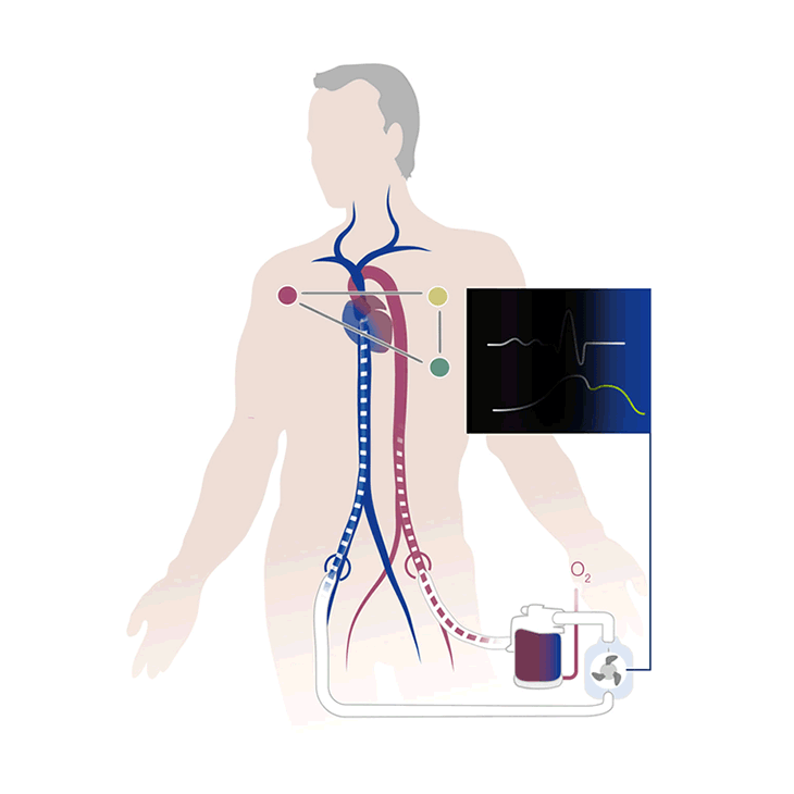Heart and lung support | Fresenius Medical Care