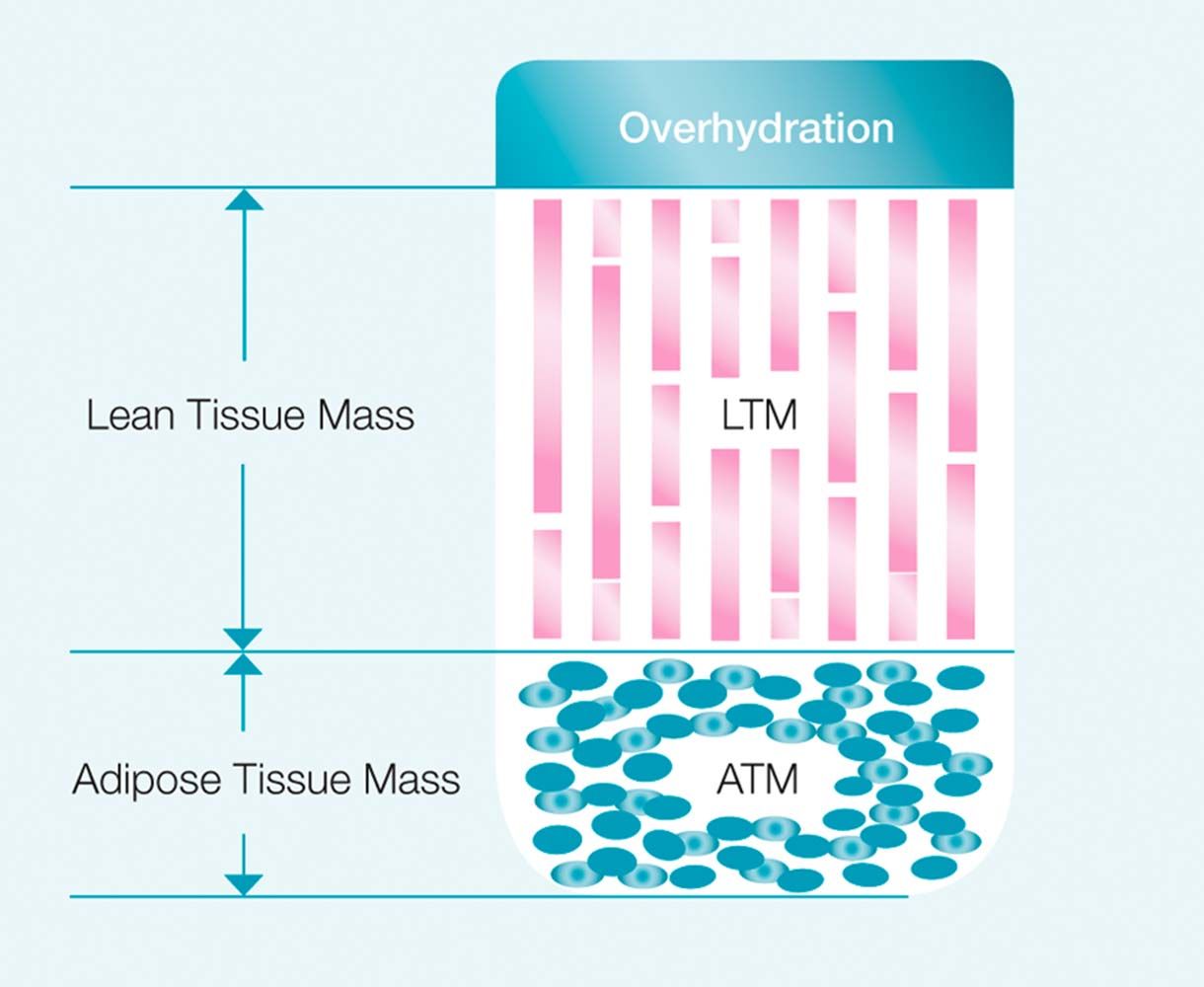 HD fluid management | Fresenius Medical Care